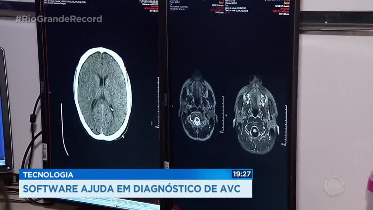 Software ajuda em diagnóstico de avc - Record TV RS - R7 Record TV RS